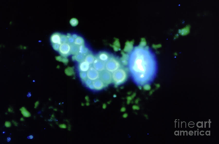Cryptococcus Neoformans Fungus From Nasal Sample Photograph by 'Dr ...